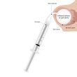 Word Bartholin Catheter Kit - Gynex Corporation
